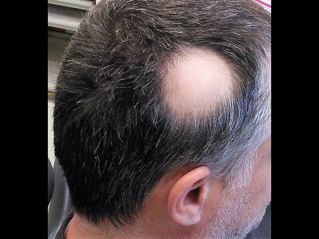 Is Hair Loss Permanent? - Urmil Skin Clinic