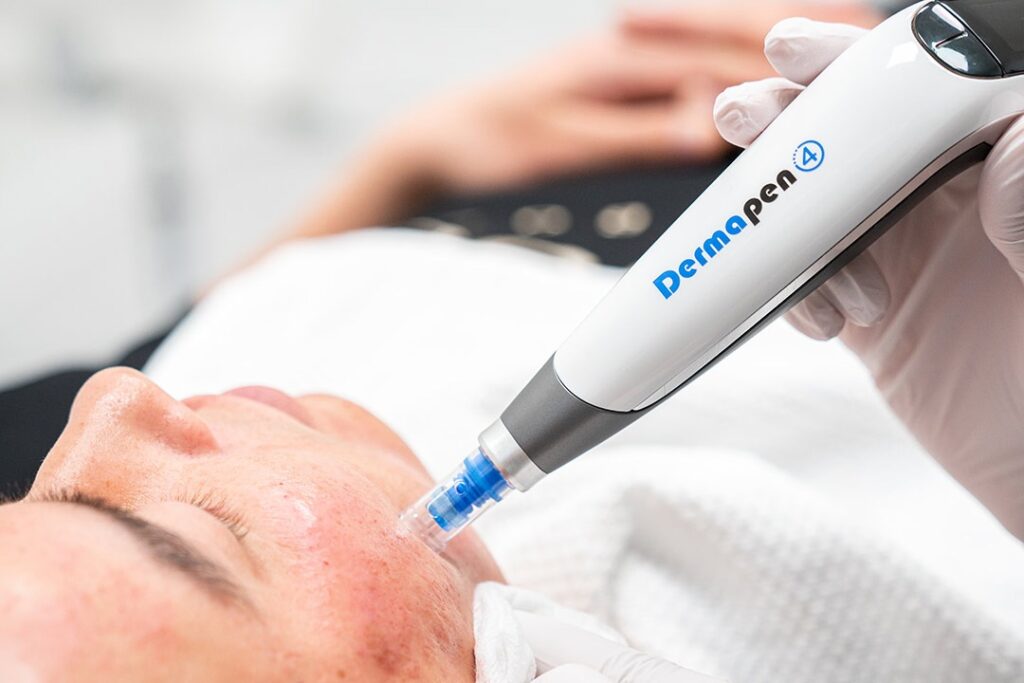 Are you suffering from Black Dots on Your Nose? Here's What You Need to ...
